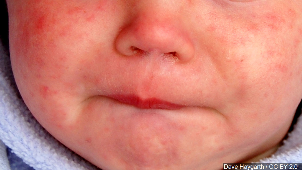 North Carolina health officials urge measles precautions | WCTI